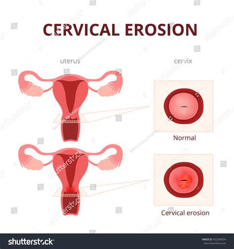 Cervical Erosion Schematic Illustration Uterus Cervix Stock Vector