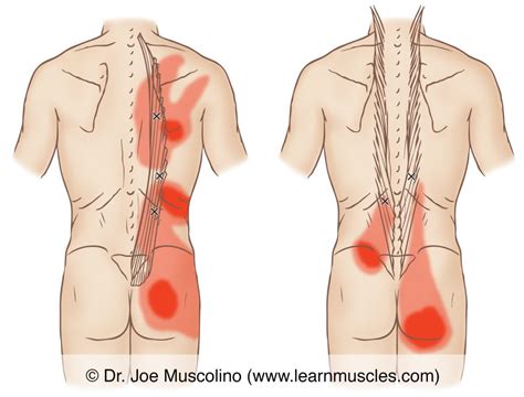 Iliocostalis And Longissimus Trigger Points Learn Muscles