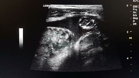 Meckel Diverticulum Perforation Ultrasound Case Youtube