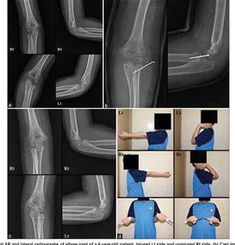 figure 2 from clinical and radiographic outcomes of pediatric radial