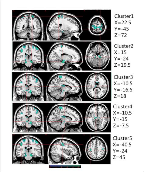 Figure Gray Matter Volume Decreased In Specific Cerebral Areas In The