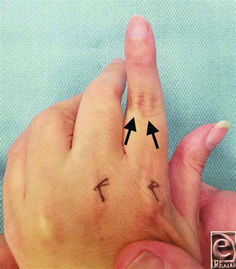 Swan Neck Deformity In Cerebral Palsy