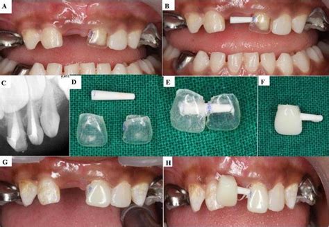 Pre Operative Radiographs And Pictures Download Scientific Diagram