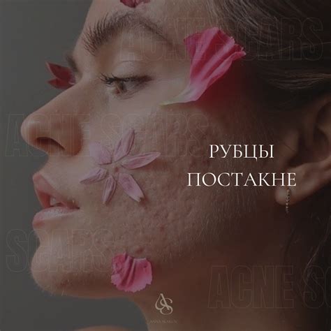 Откуда берутся рубцы после акне С чистого лица Анна Скакун Дзен