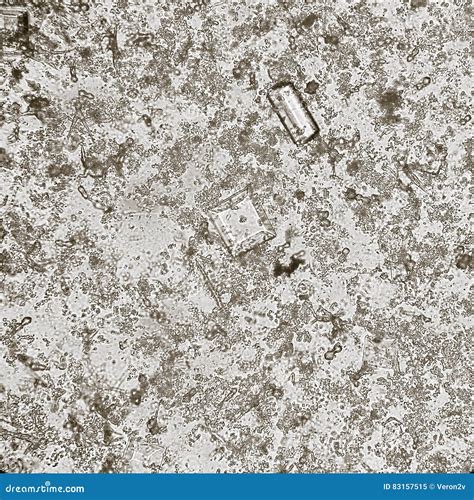 Amorphous Urates In Urine