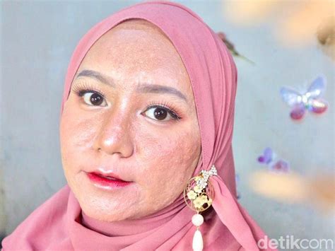 Berita Dan Informasi Acne Fighter Terkini Dan Terbaru Hari Ini Detikcom