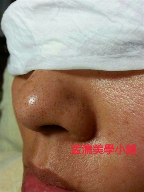 臉部粉刺如何處理改善【問題皮膚篇】 孟濡極緻美學
