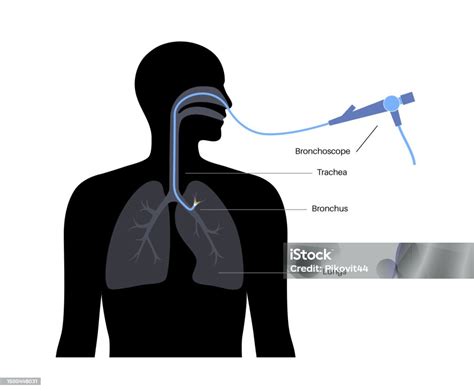 기관지 내시경 검사 절차 개념 0명에 대한 스톡 벡터 아트 및 기타 이미지 0명 감기와 독감 건강 진단 Istock