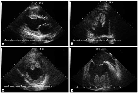Initial Transthoracic A B And C And Transesophageal D