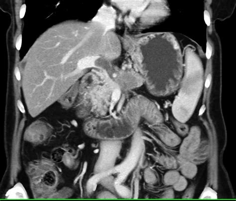 Pancreatic Cancer Invades The Portal Vein Splenic Vein And Superior