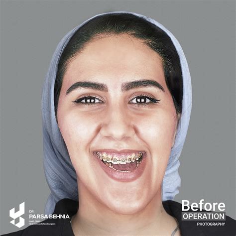 ‎dr Parsa Behnia دکتر پارسا بهنیا‎ ‎🗒️ خانم ۲۱ ساله با شکایت اصلی جلو بودن و کج بودن فک