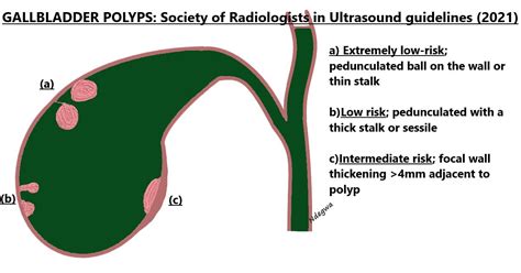 Sru Guidelines On Gallbladder Polyps David Ndegwa Posted On The Topic Linkedin