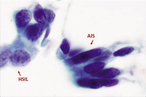 Atypical Glandular Cells AGC Cytology Of Glandular Lesions Of The Uterine Cervix CytoJournal
