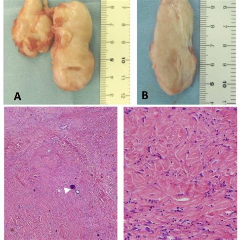 Download Pdf Bilobular Calcifying Fibrous Pseudotumor In Soleus