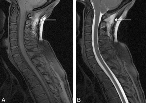 Cerebrospinal Fluid Leak Spine