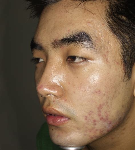 How To Use The Acne Object Detection Api