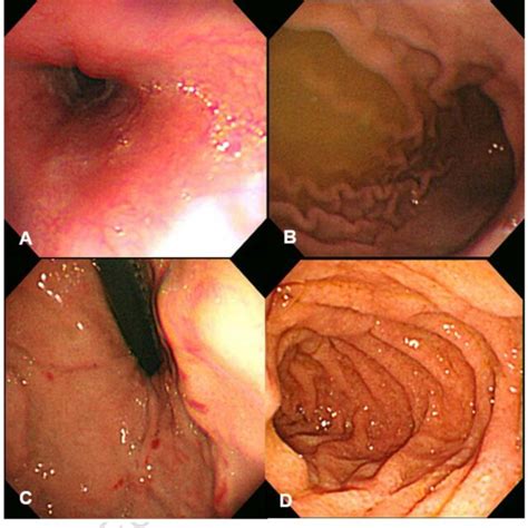 Follow Up Endoscopic Findings Day 13 The Previous Bleeding And