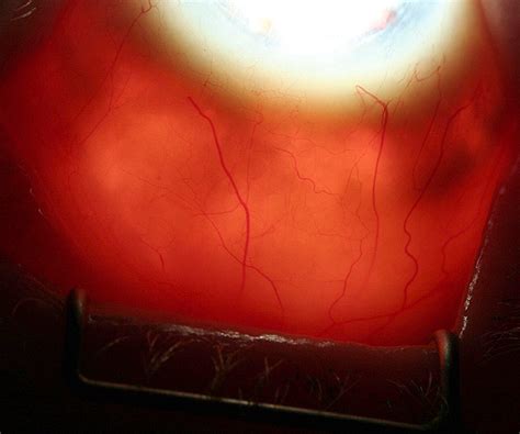 A Modified Digital Slit Lamp Camera System For Transillumination