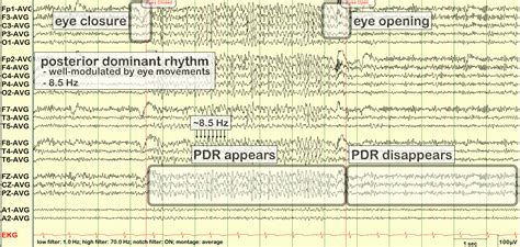 Posterior Dominant Rhythm