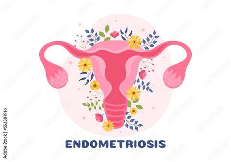 Endometriosis With Condition The Endometrium Grows Outside The Uterine