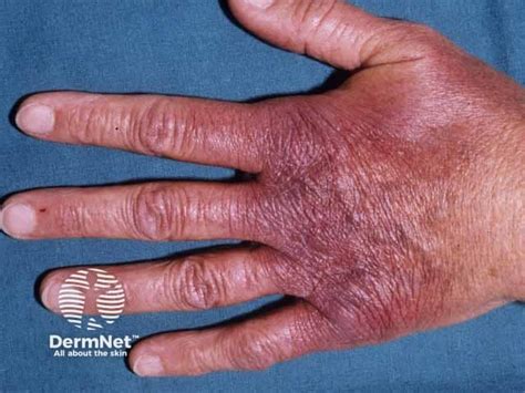 Acrodermatitis Chronica Atrophicans