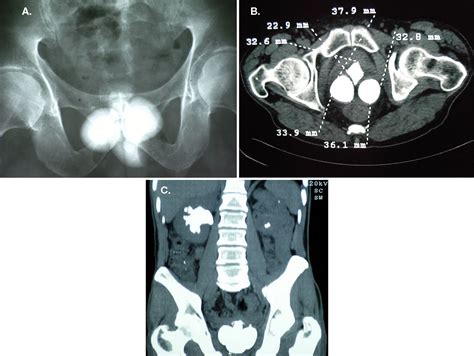 Large Prostatic Stones With Staghorn Renal Calculus In A 61 Year Old