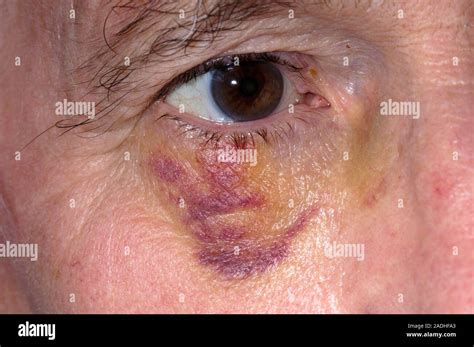 Post Op Bruising Of The Eyelid Bruised Lower Eyelid Of A 75 Year Old