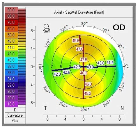 Astigmatism Management In Modern Cataract Surgery