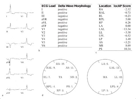 A Representative Example Of A Patient With An Accessory Pathway For Download Scientific Diagram