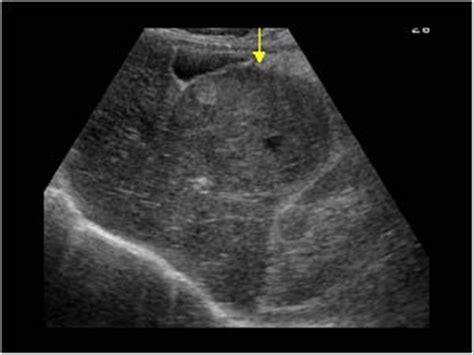Hepatocellular Carcinoma Ultrasound