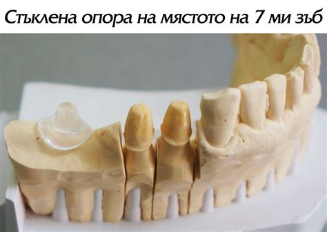 Изработване на мост върху стъклена опора Д р Ралев зъболекар