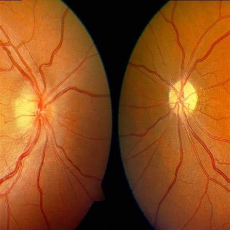 Fundus Picture Of Both Eyes Showed Optic Disc Edema In The Right Eye