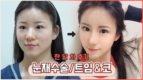 성형브이로그 레전드 풀트임 🤩눈트임성형전후 와 코성형전후 🧐코성형수술 후기 인터뷰 단추구멍 눈에서 왕눈이로 트임수술