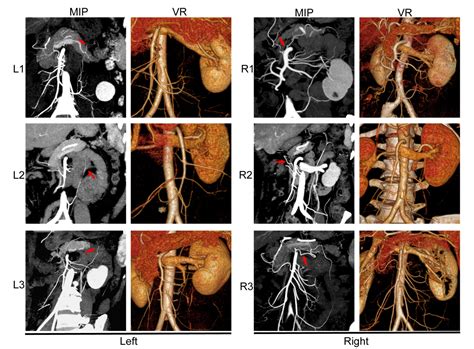 Figure 2 From The New Concept Of Physiological “riolans Arch” And The