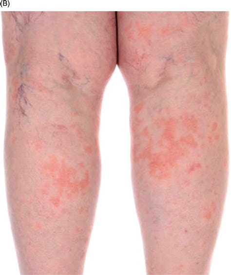 Urticarial Vasculitis Face