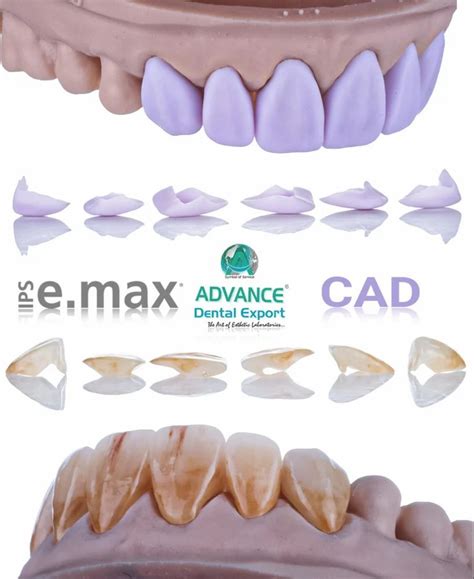 Ceramic Manual Ips Flexible Partial Denture For Clinical At Best Price