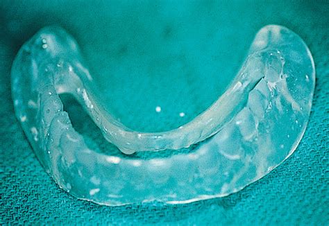 9 Root Form Implant Surgery Generic Pocket Dentistry