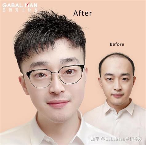 假发像真的一样？贾博补发效果太好了，如同整容手术 知乎
