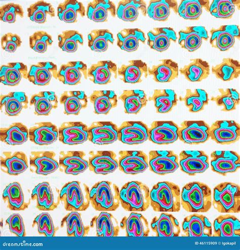 Nuclear Myocardial Perfusion Stress Test Stock Image Image Of Stress Heart 46115909