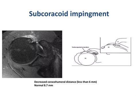 Impingment Syndrome And Rotator Cuff Tearpptx