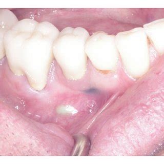 Mucobuccal Fold An Apically Positioned Flap And Free Gingival Graft