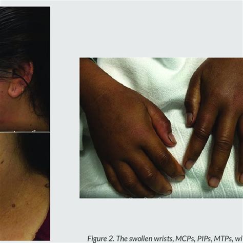 The Non Blanching Non Scaly Rash Faint Erythematous Download