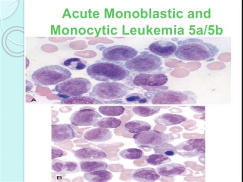 Monoblastic Leukemia