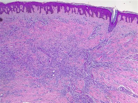 Cellular Dermatofibroma A O Que é Dermatofibroma E Como Eliminar