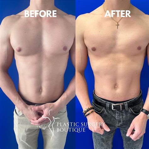 Gynecomastia Surgery Galleries Plastic Surgery Boutique