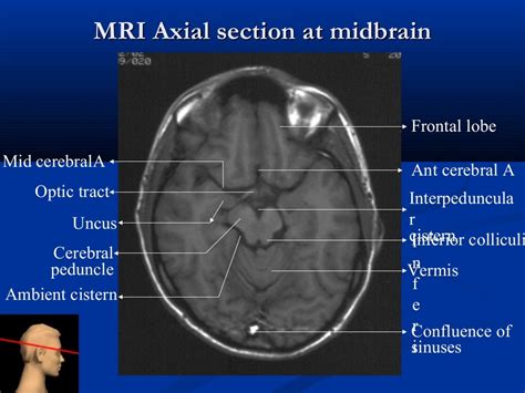 Radiological Techniques Of Brain Space Occupying Lesion