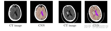 文献速递：人工智能医学影像分割 Mr Ct多图谱配准，由完全自动化的基于cnns的大脑结构分割引导 知乎