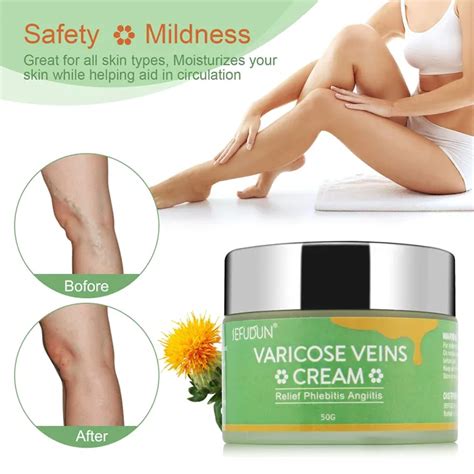 Authentic Varicose Vein Cream 50g Lazada PH