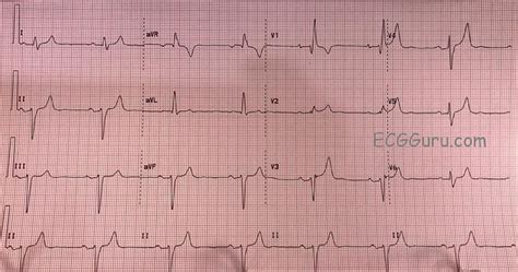 Bifascicular Block Ecg Guru Instructor Resources