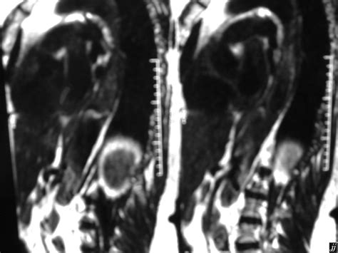 Abdomen Renal Artery Origin Stenosis With Aortic Dissection Mra 12